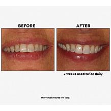 intelliWHiTE | Shop Teeth Whitening Kits, Toothpaste & Toothbrushes | HSN