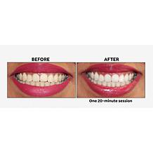 Teeth Whitening Kits & Products | Oral Care Products | HSN