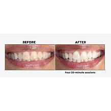 intelliWHiTE | Shop Teeth Whitening Kits, Toothpaste & Toothbrushes | HSN